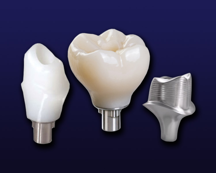 Custom Abutments - Stoller Dental Lab