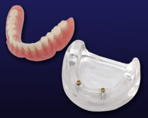 Locator Dentures - Stoller Dental Lab