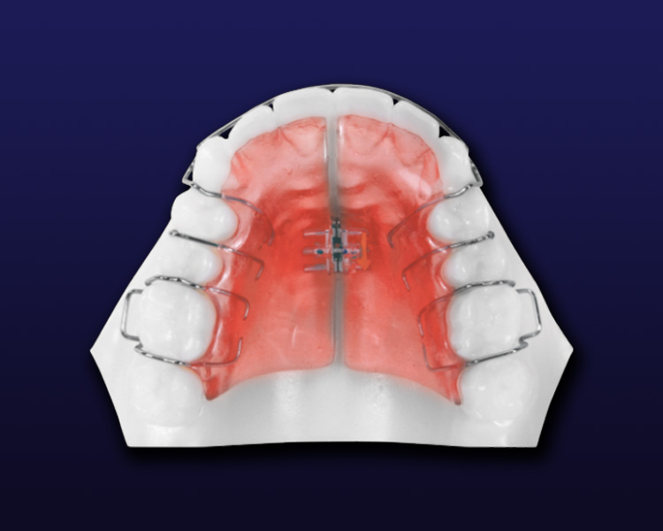 Removable Appliances - Stoller Dental Lab